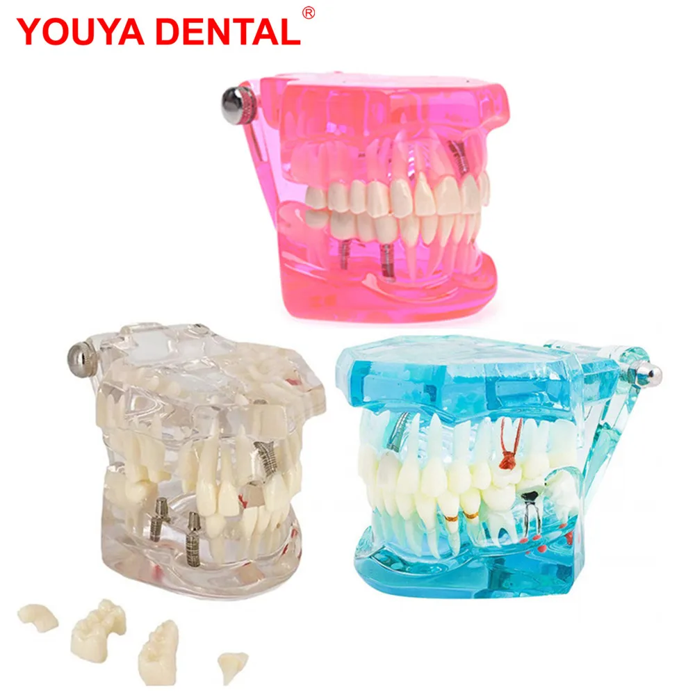 Dentistry Implant Dental Models For Patient Education Communication ...