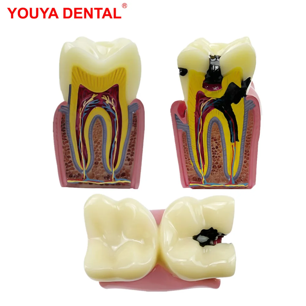 Dental-Model-Caries-Teeth-Model-Large-Dental-Anatomical-Model-Tooth ...