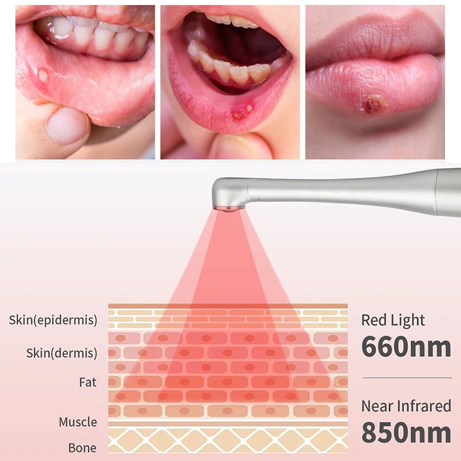 Cold Sore Laser Therapy Device Light Therapy Mouth Ulceration Blisters ...