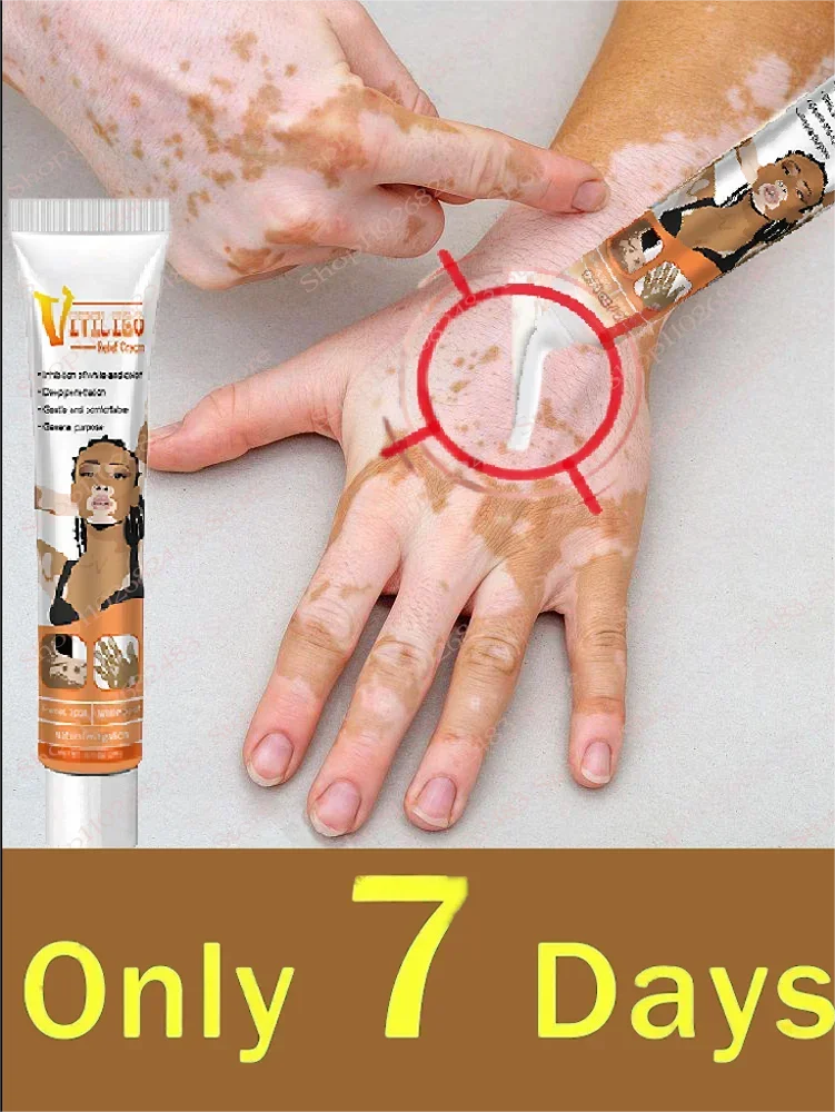 Vitiligo-Cream-Improves-The-Skin-and-Reduces-Vitiligo-Repair-for ...