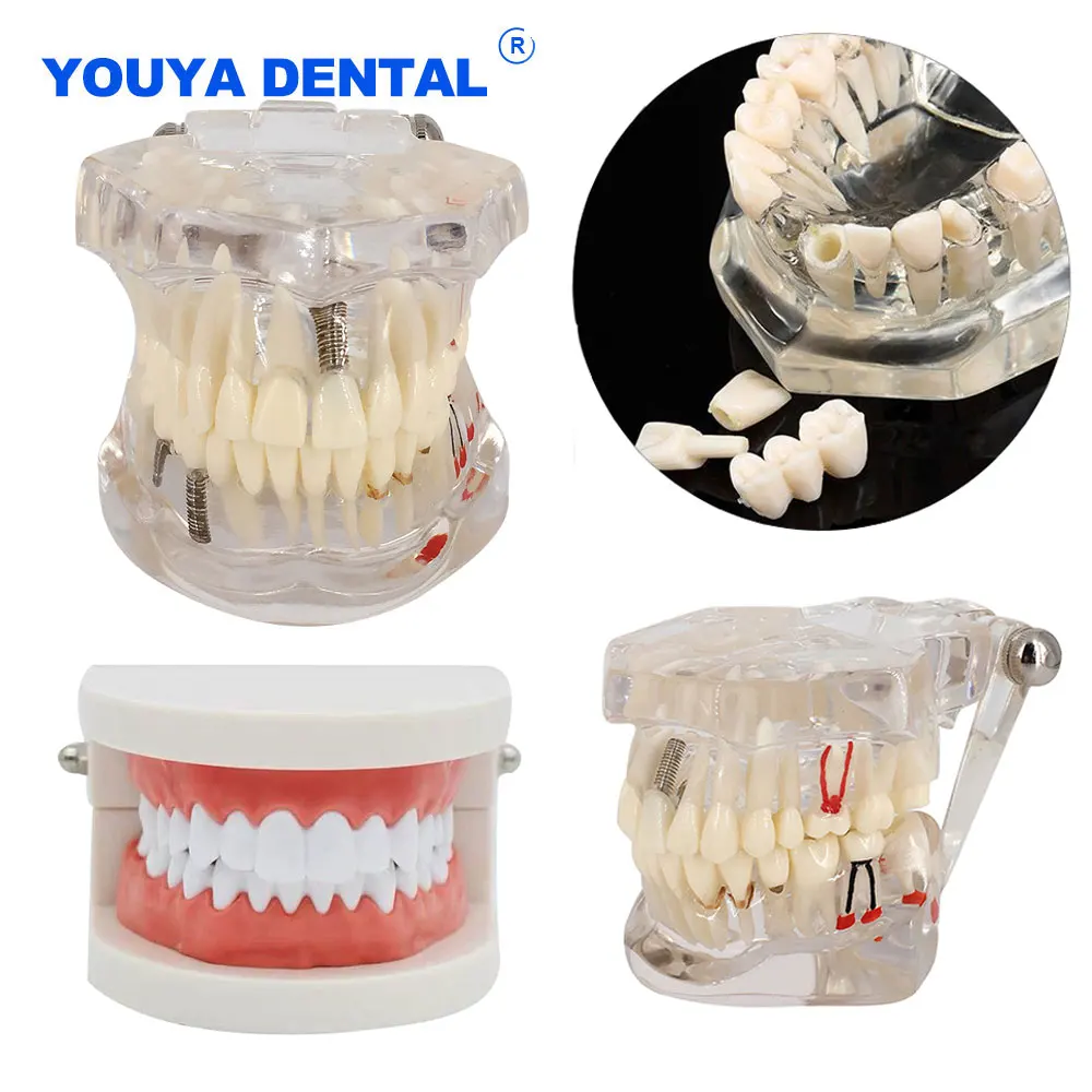 Dental-Implant-Teeth-Model-Transparent-Disease-with-Restoration-Bridge ...