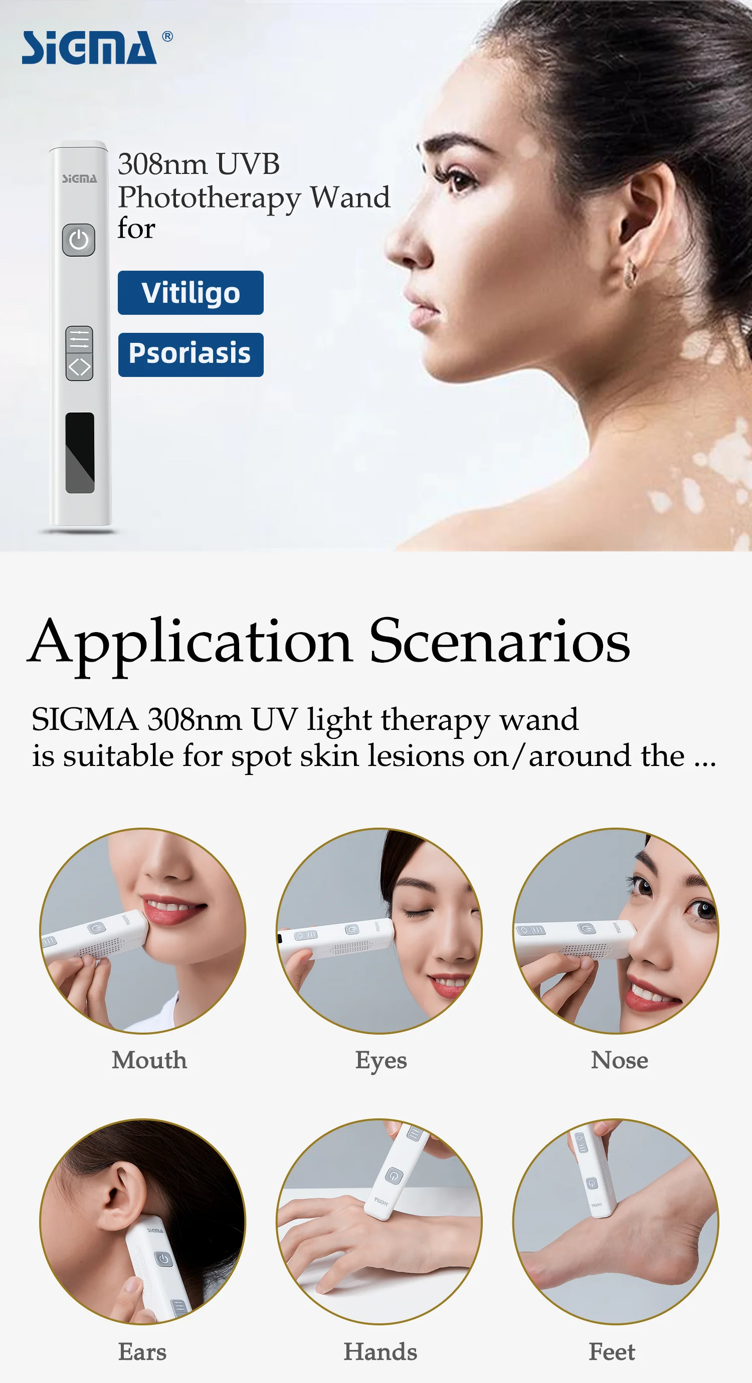 SIGMA Mini 308nm 엑시머 레이저 UVB 광선요법 기계 백반증 건선 치료를 위한 자외선 치료 장치 _ - Alisa