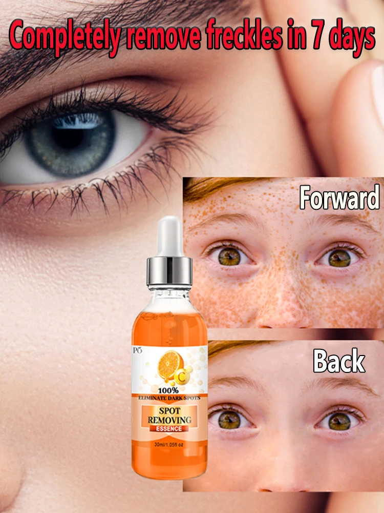 Facial-dark-spot-removal-sun-protection-chloasma-freckles-pigmented-age ...