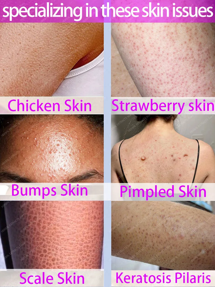Keratosis Pilaris Treatment Before And After