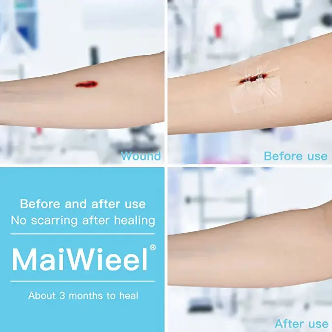 2PCS-Zip-Stitch-Sutures-BAND-Kit-Waterproof-Strips-Wound-Closure ...