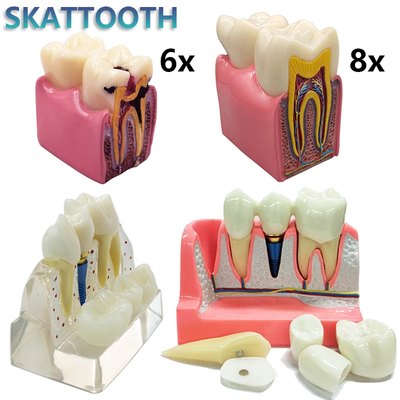 Dental-Implant-Model-6-8x-Magnified-Caries-Contrast-Tooth-Model-Crown ...