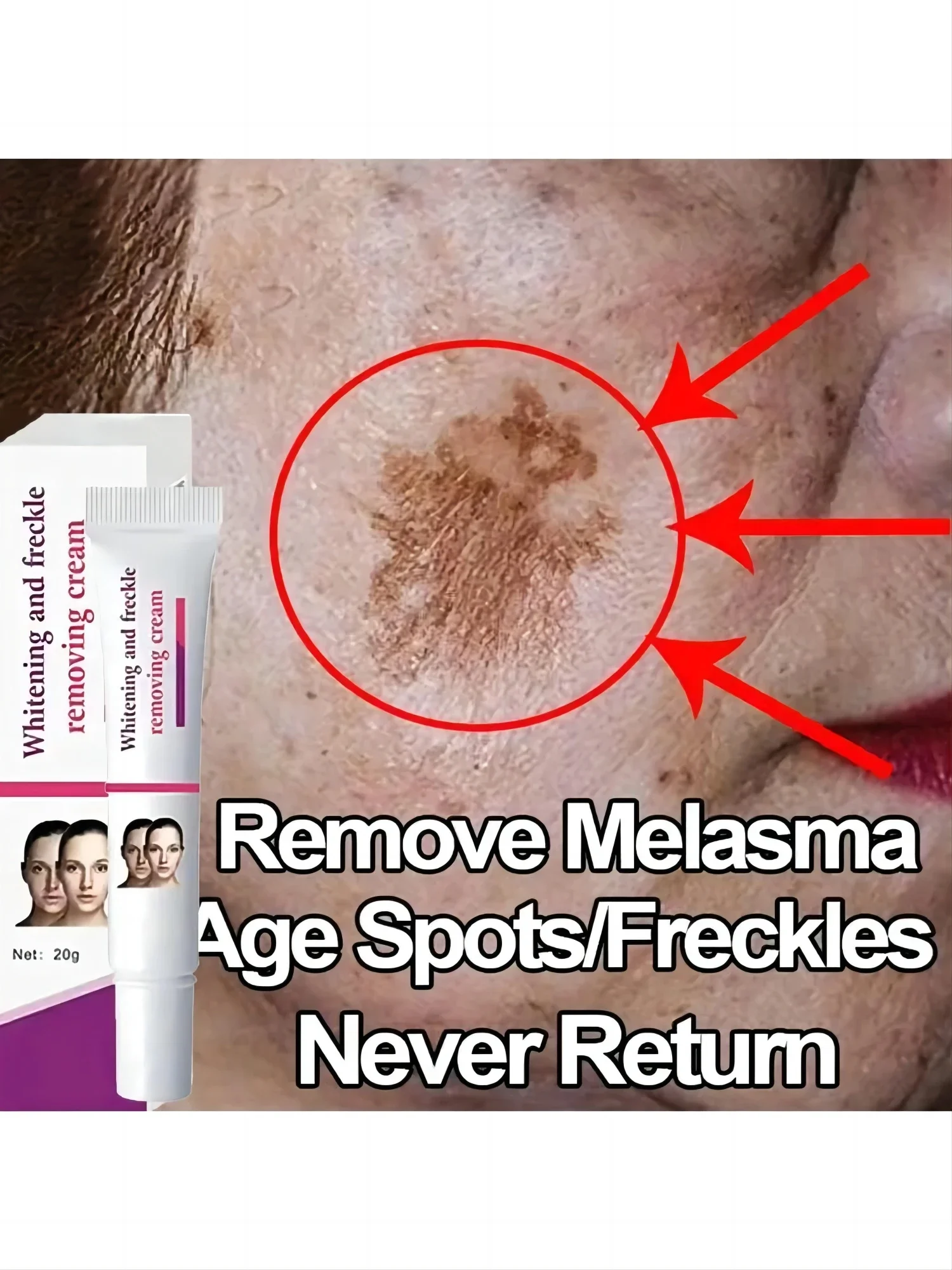 Freckles-Removal-Cream-Remove-Facial-Spots-Skin-Dark-Spot-Remove ...
