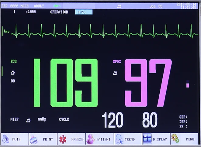 Cardiac Monitor Screen