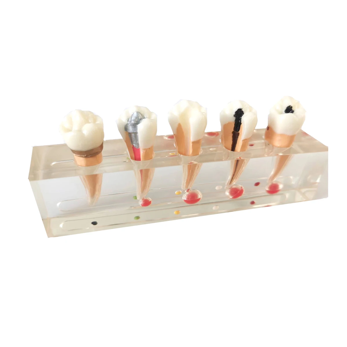 Dental-Tooth-Model-Dental-Endodontic-Model-Demonstrates-5-Stages-Of ...