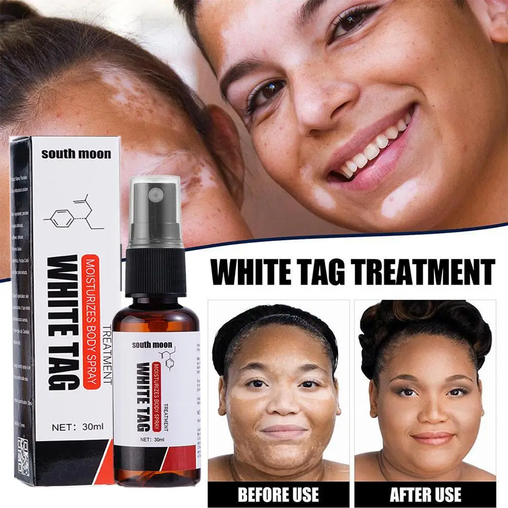 White Spot Remover Spray Herbal Antibacterial Vitiligo Leukoplakia ...