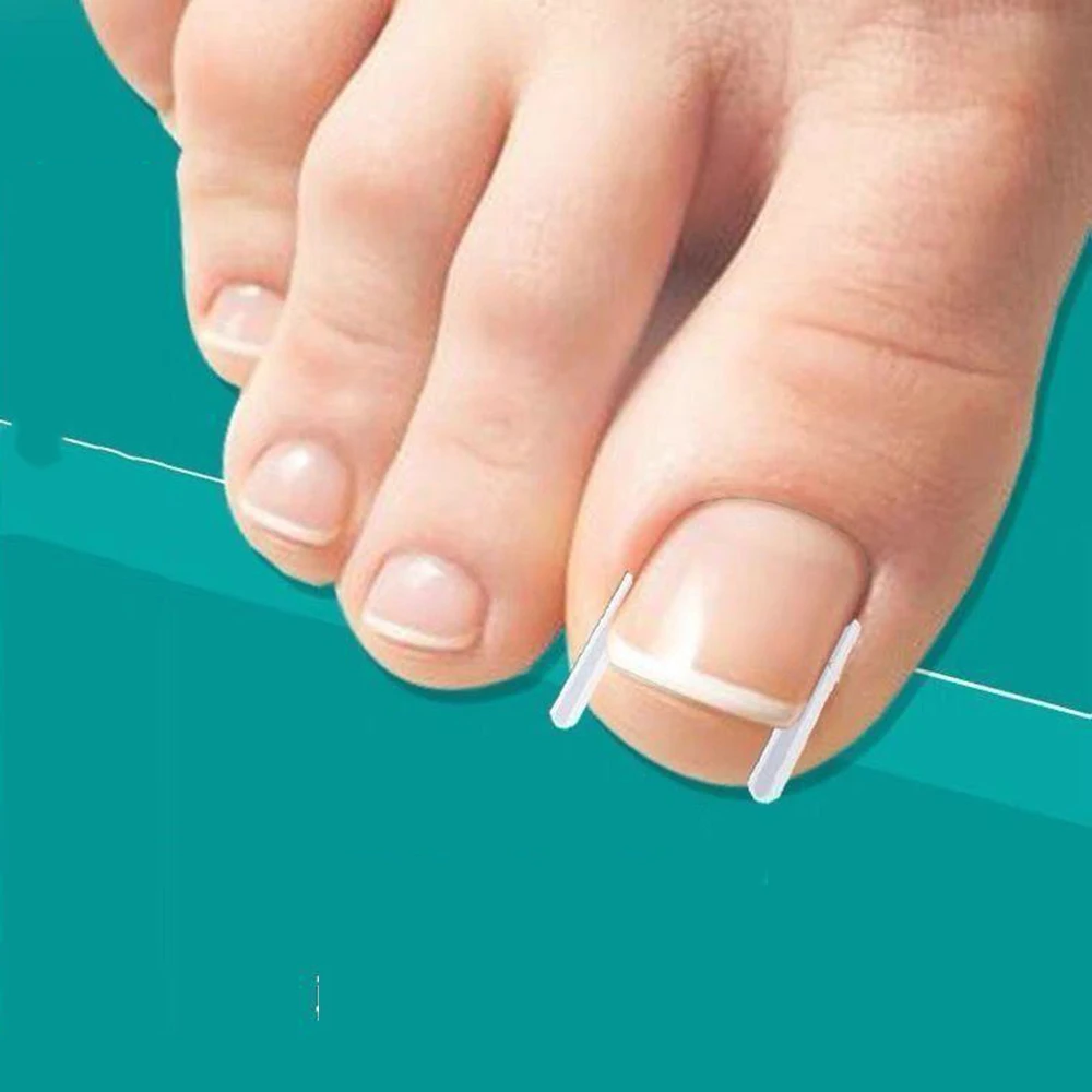 50PCS-Set-of-Nail-Groove-Pads-Ingrown-Toenail-Filling-Pads-Paronychia ...