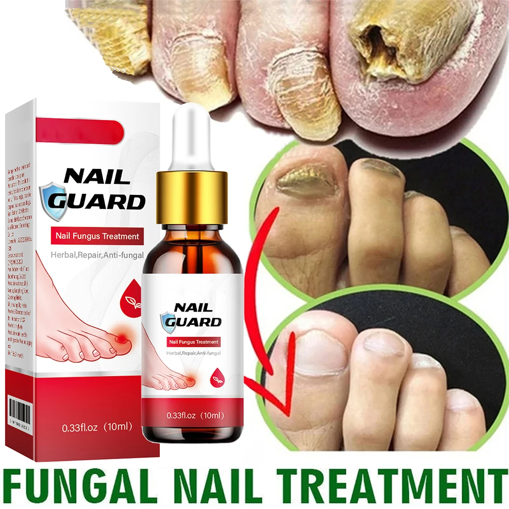 Nail-Fungal-Treatment-Nail-Fungus-Liquid-Nail-Oil-Thick-Toe-Care-7-Days ...