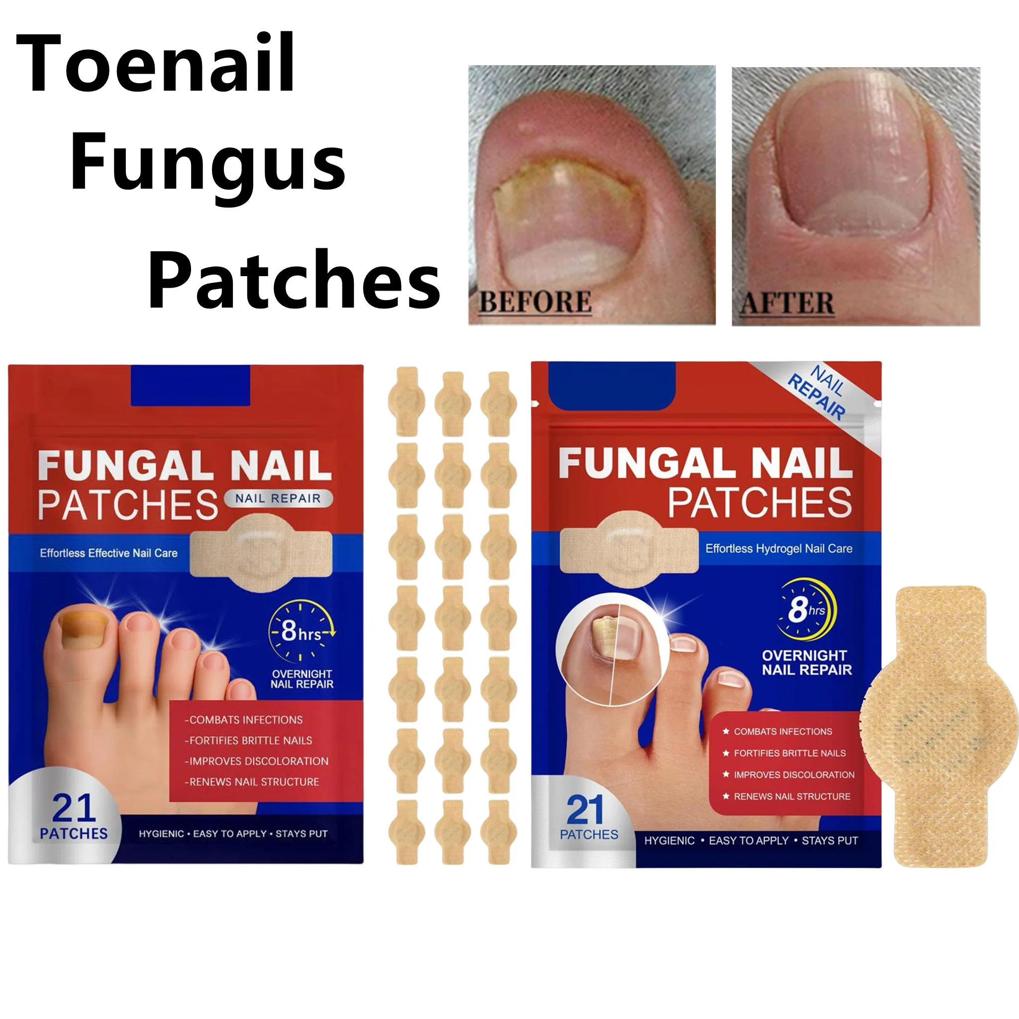 Fungal Ingrown Toenail Treatment: Effective Solutions for Healthy, Pain ...