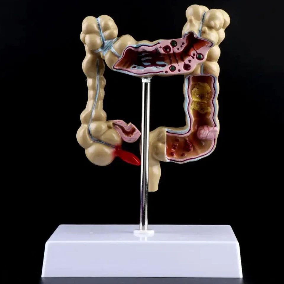 Large Intestine Model With Diseases Anatomystuffcouk Intestinal