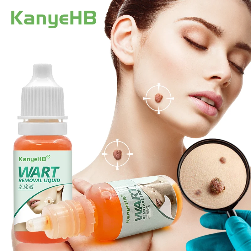 Eliminador de verrugas líquido a base de hierbas, para la piel tratamiento medicinal, callos ...