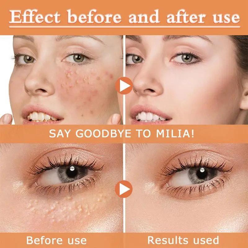 Milia Removal Before And After