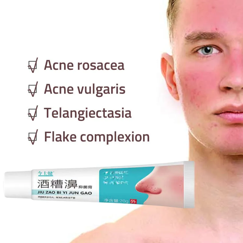 Nase Haut Rosacea Behandlung Creme Akne Milben Rosacea, 03/01/2024