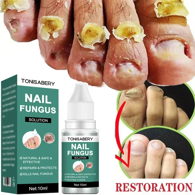 Nail Fungus Treatment Serum Foot Repair Liquid Toe Nails Fungal Removal ...