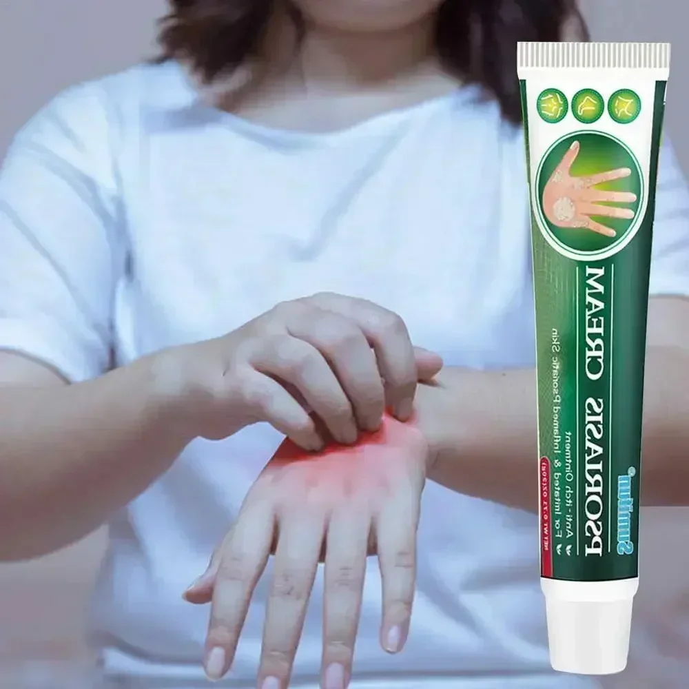 Противогрибковый крем от псориаза | AliExpress