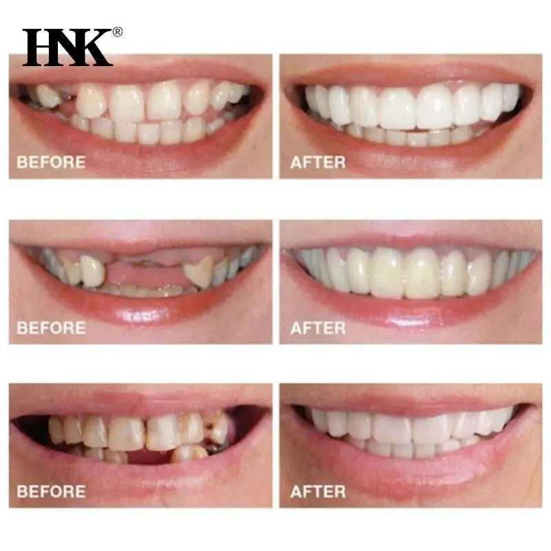 Silicone Upper/lower False Teeth Dentures Paste Oral Hygiene Tools Fake ...