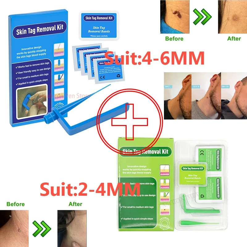 Medical-Skin-Tag-Remover-Kit-Micro-Band-Papilloma-Removal-Patches ...