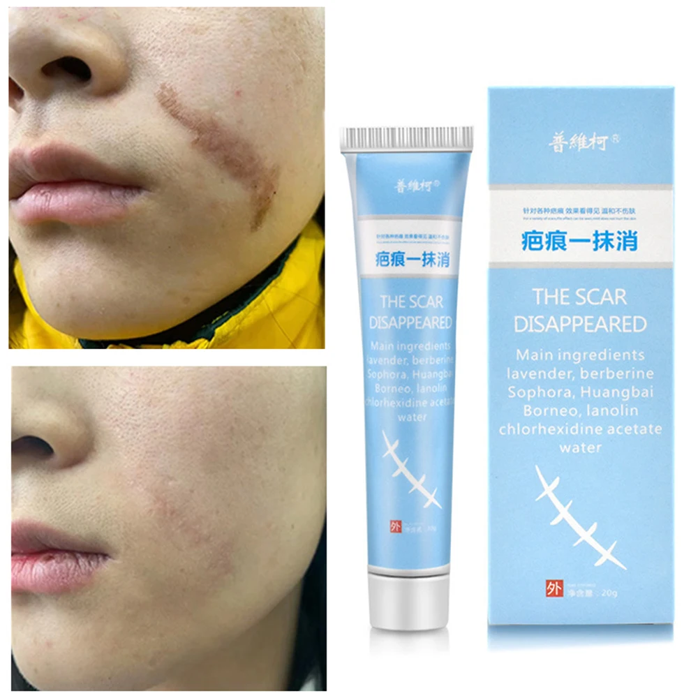 Scar Removal Cream Herbal Hyperplasia Acne Marks Scars For Burns Surgery Plastic Surgery Scars ...