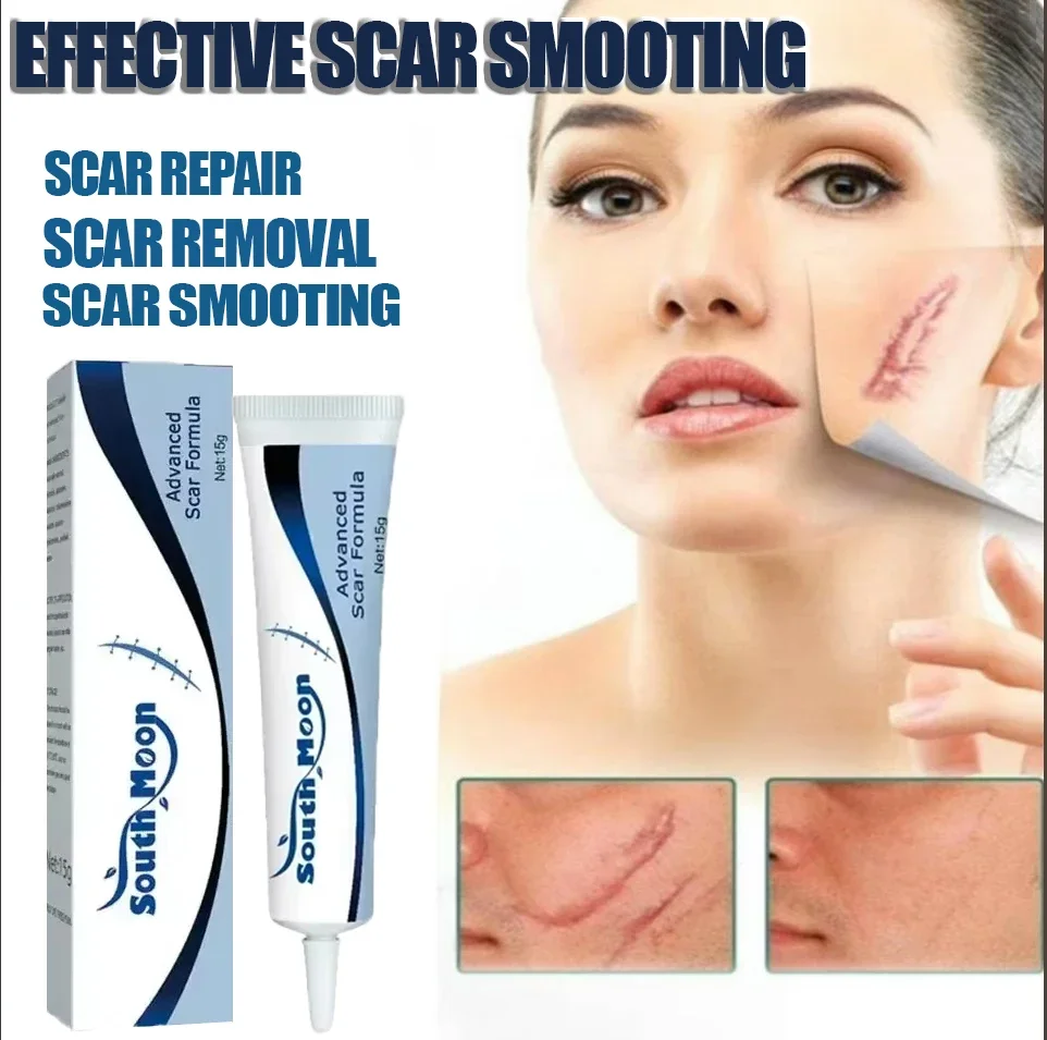 Acne-Scar-Stretch-Marks-Remover-Cream-Postoperative-scar-repair-Skin ...