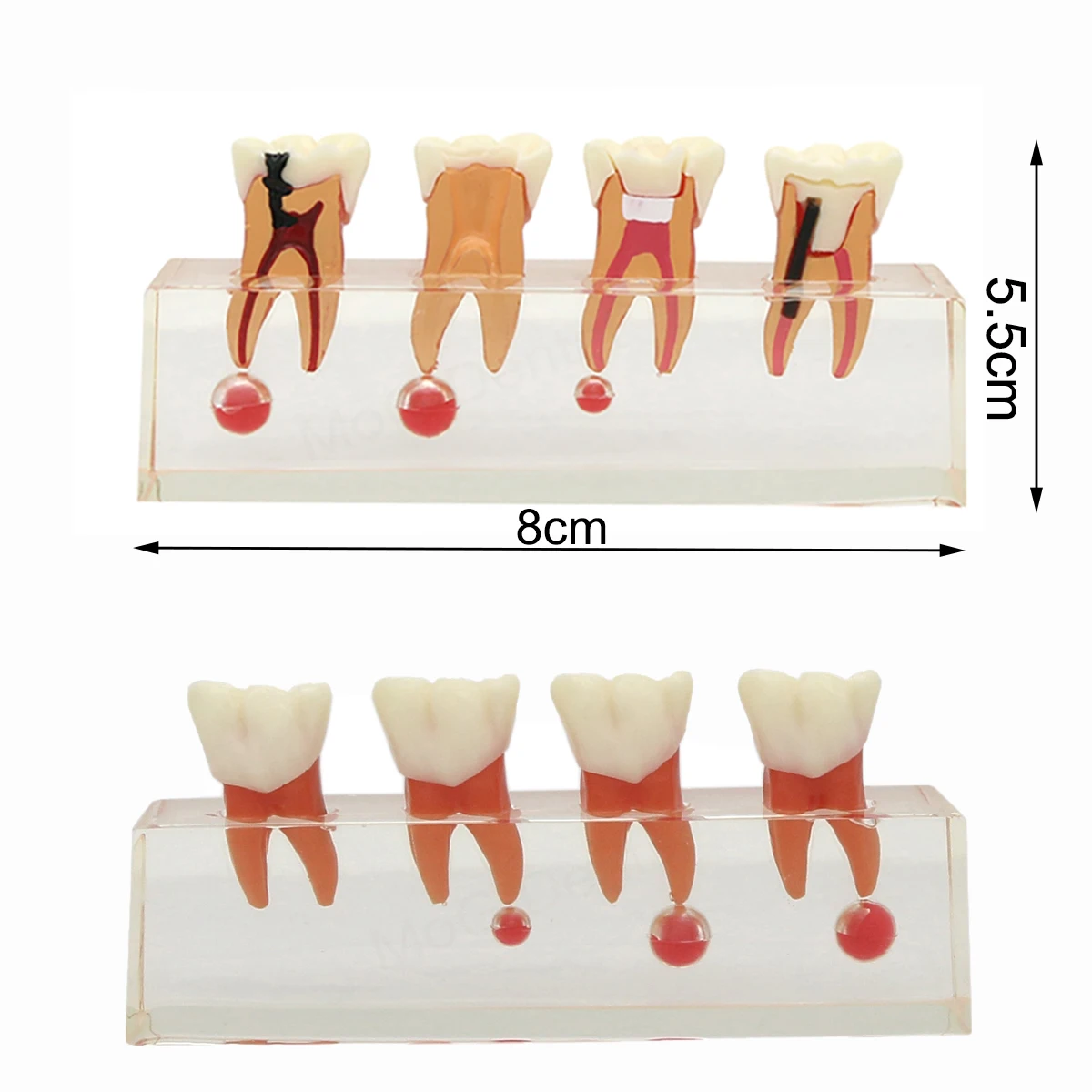 Dental-Models-with-Endodontic-Pathological-Treatment-Dental-Teaching ...