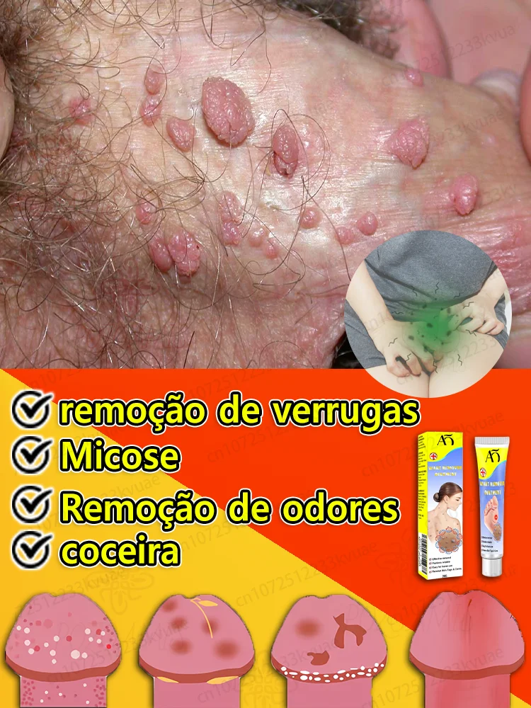 Creme-para-remo-o-de-verrugas-HPV-Verrugas-genitais-Verrugas-plantares.png