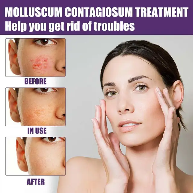 What Is Molluscum Contagiosum? Treatment And Home Remedies, 54% OFF