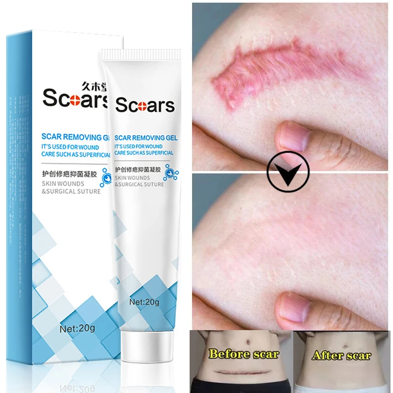 Scar-Removal-Cream-Herbal-Repairing-Pock-Mark-Burn-Surgical-Scar-Cesarean-Old-Scars-Stretch ...