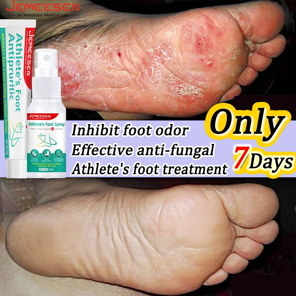Herbal-Foot-Tinea-Beriberi-Pedis-Treatment-Cream-Spray-Anti-Smelly ...