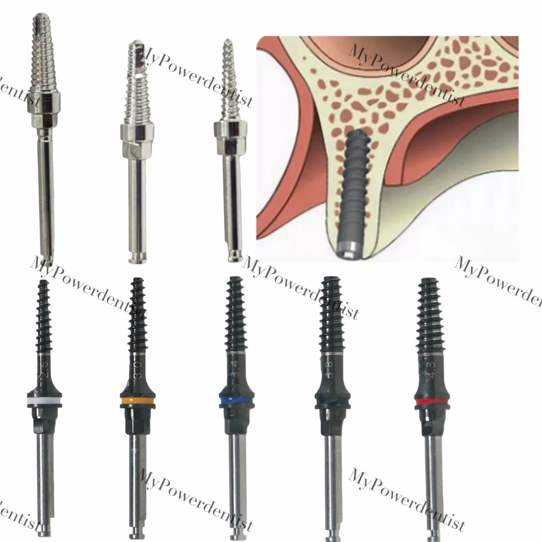 Hiossen-Titanium-Expans-o-Parafusos-Expansor-Implante-Split-Drill ...