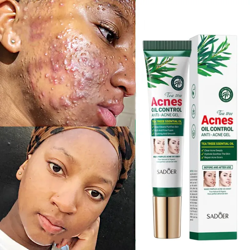 Acne-cream-herbal-essence-anti-inflammatory-anti-acne-anti-acne-anti ...