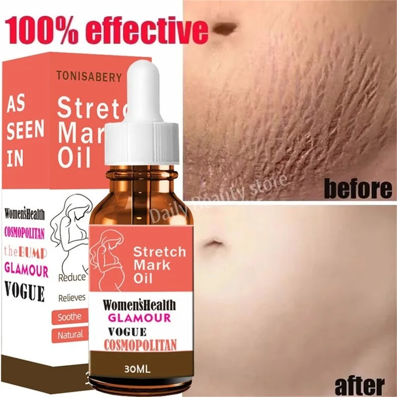 Stretch-Marks-Remover-Essential-Oil-Pregnancy-Maternity-Body-New-Old-Stretch-Mark-Removal-Serum ...