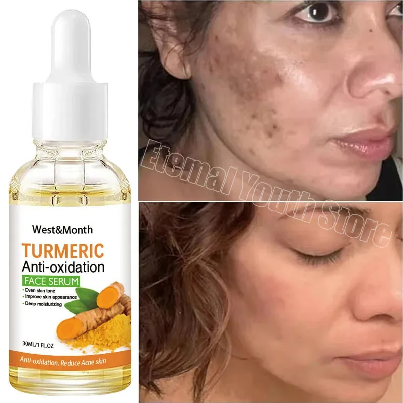 Turmeric-Dark-Spot-Remover-Face-Serum-Whitening-Freckle-Melanin ...