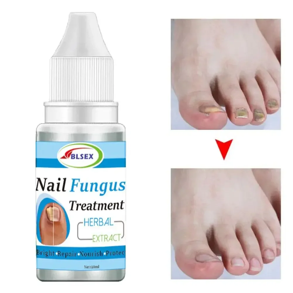 U-as-Fungus-Nails-Treatment-for-Fingernails-Toenails-Repair ...