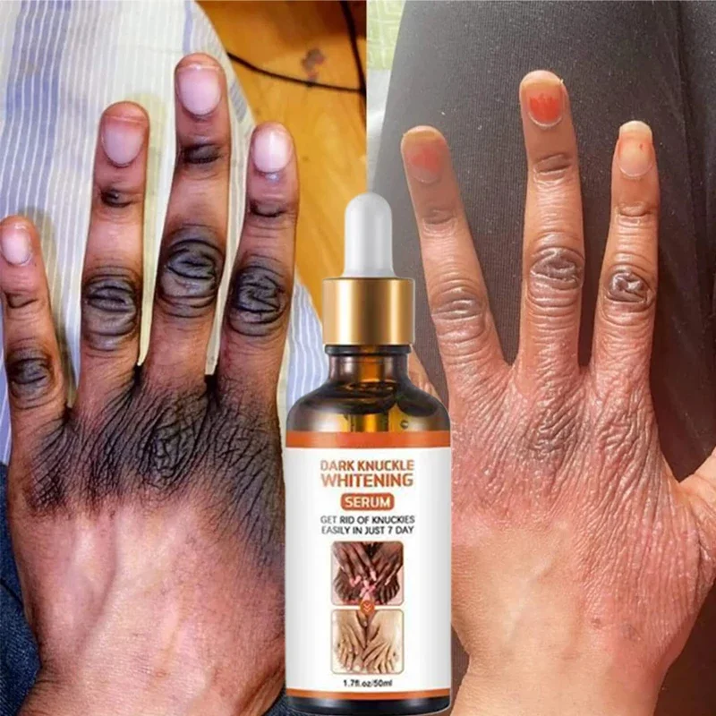 50ml-7-days-Nicotinamide-Black-Fingers-Remover-Nicotinamide-Get-Rid-of ...