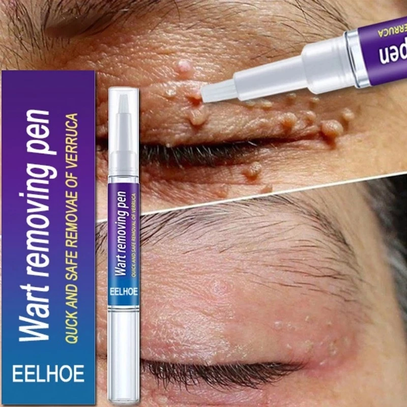 2pc verrugas removedor líquido antibacteriano pomada verruga tratamento ...