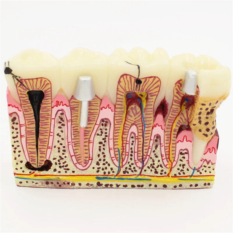 Dental-Caries-Comparation-Anatomy-Teeth-Model-for-Dental-Anatomy-Lab ...