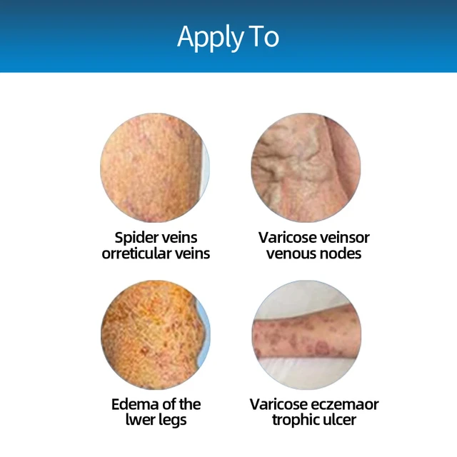 Vulvar Varicosities Treatment