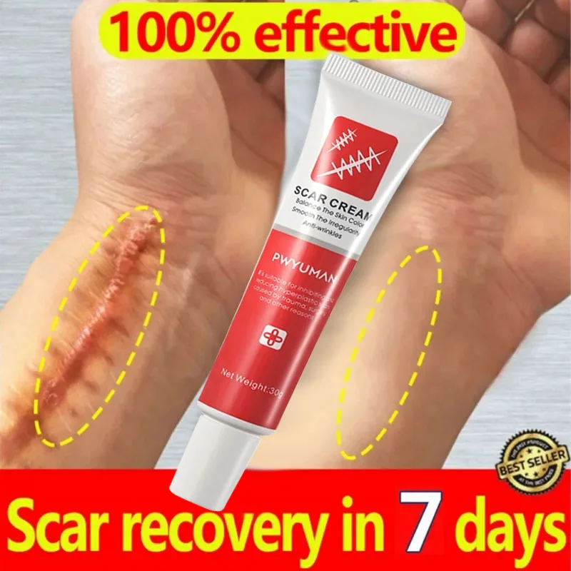 Scar-Removal-Cream-Fade-Stretch-Marks-Gel-Scald-Burn-Surgical-Scars ...