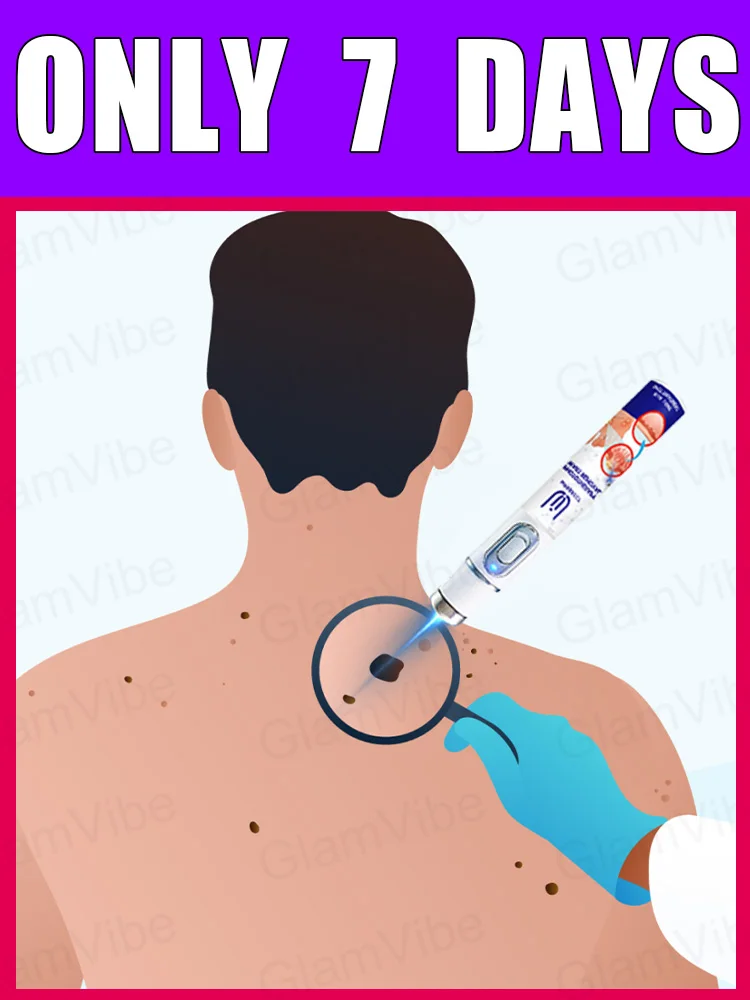 blue light pen solve warts, hot sale wart care tools - AliExpress 66