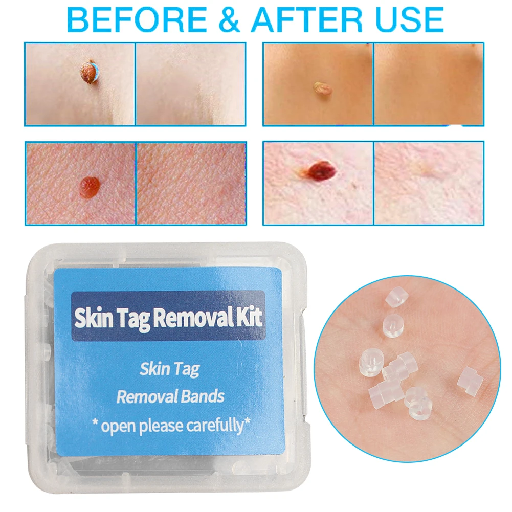 5box Skin Tag Removal Rubber Bands 4-8mm Non Toxic Face Care Mole Wart ...