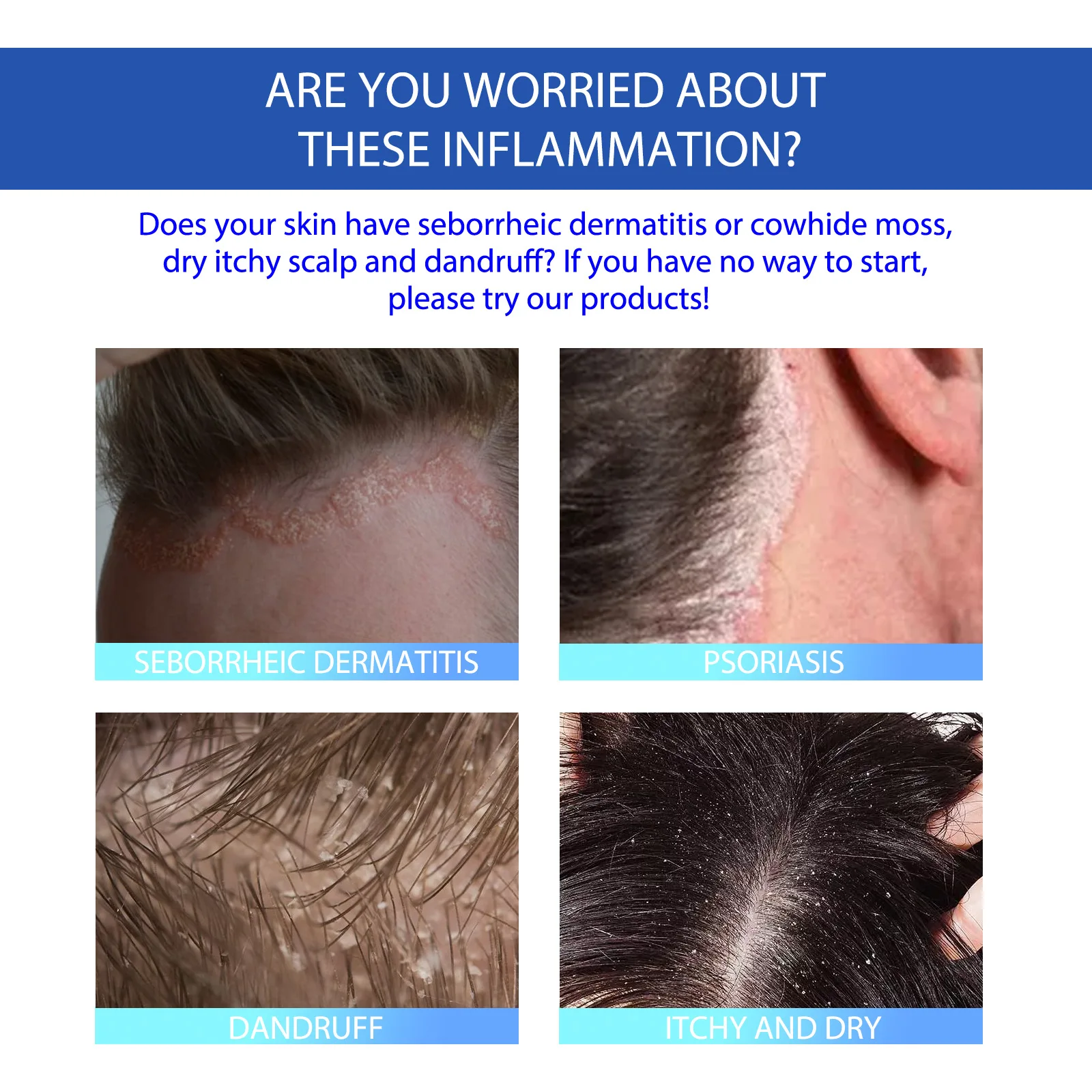 Dandruff Vs Seborrheic Dermatitis