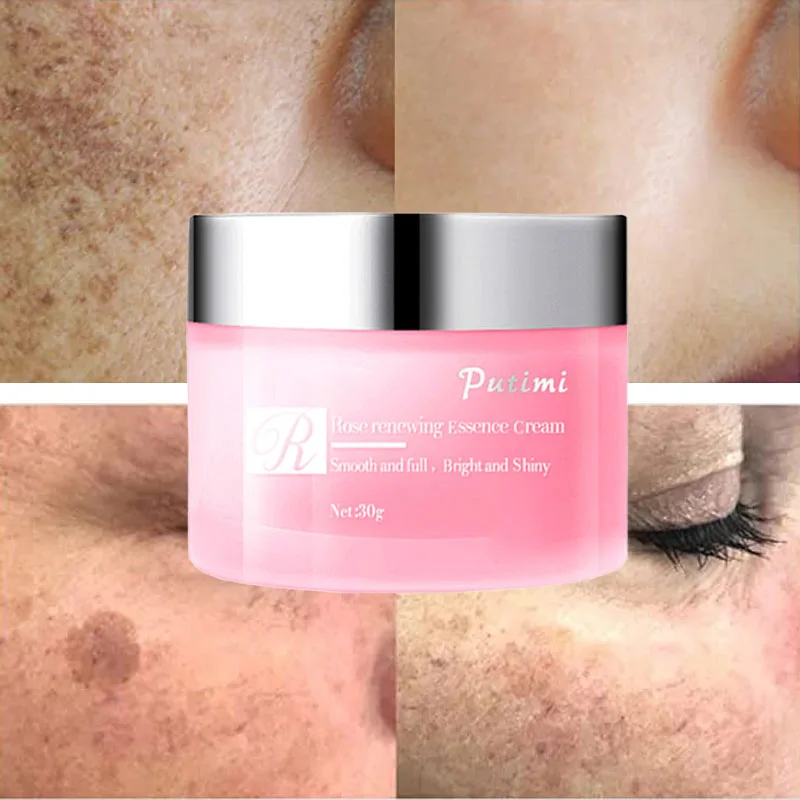 Effective-Whitening-Freckles-Face-Cream-Remove-Melasma-Dark-Spots-Fade ...