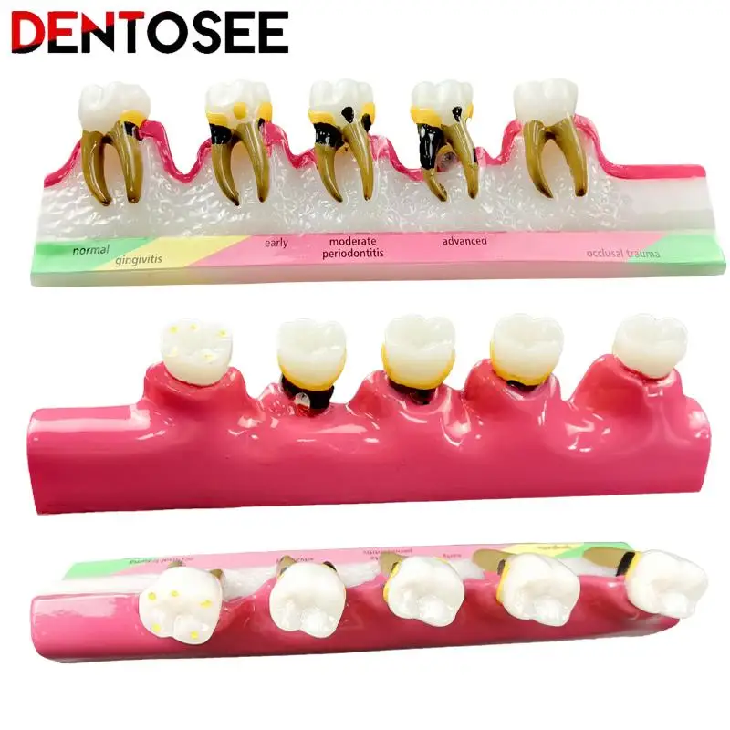 Periodontal-Disease-Classification-Demonstration-Model-5-Stages ...