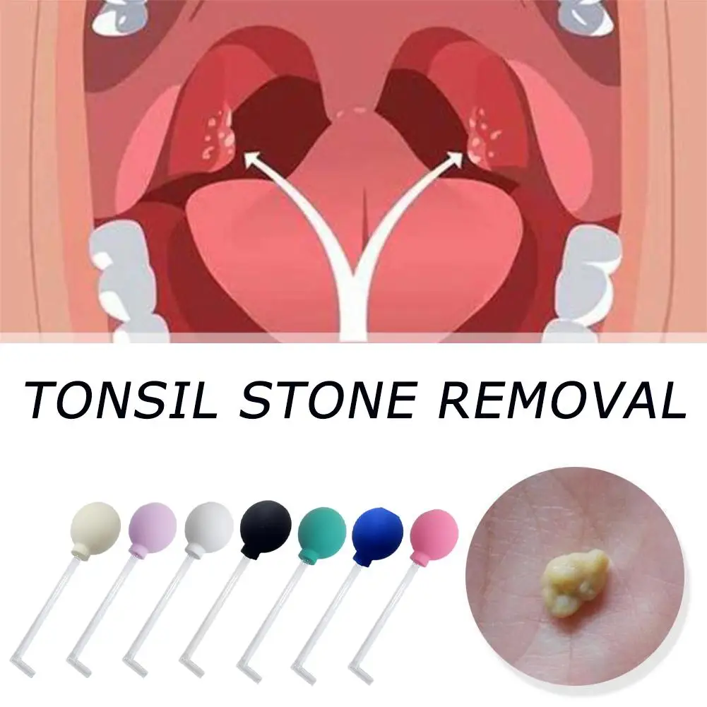 Tonsil Stones Removed