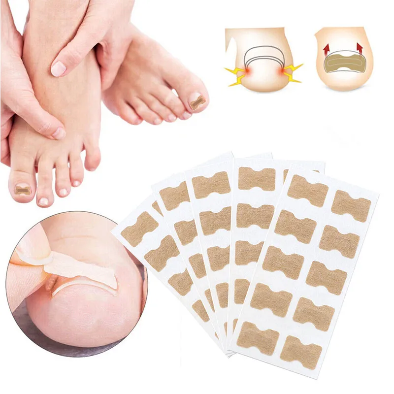 100Pcs Ingrown Toenail Corrector Sticker Foot Care Paronychia Treatment ...