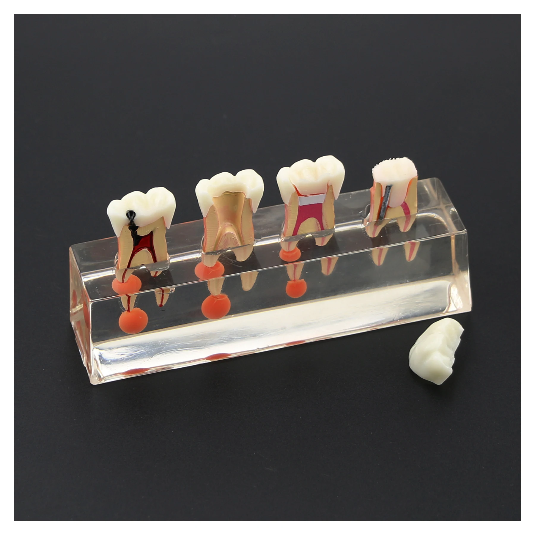 Dental Teeth Model M4018 Endodontic Treatment 4-Stage Molar Root Canal ...